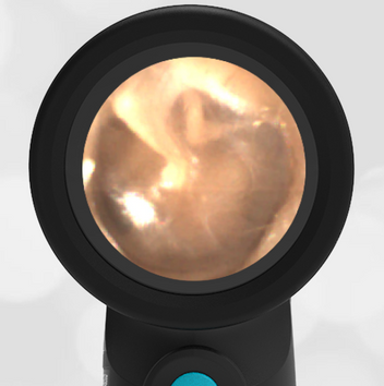 Pars Tensa and Pars Flaccida – WiscMed