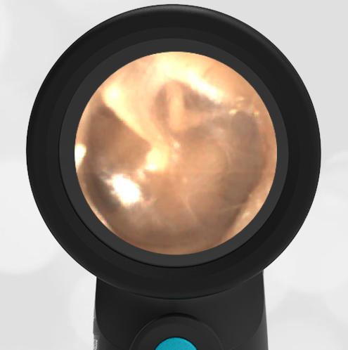 Pars Tensa and Pars Flaccida – WiscMed