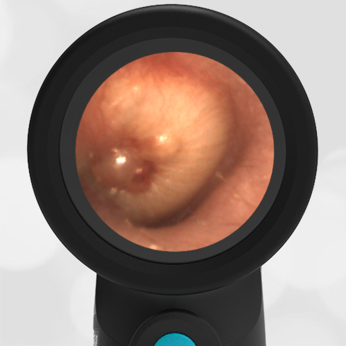 Bullous Myringitis – WiscMed