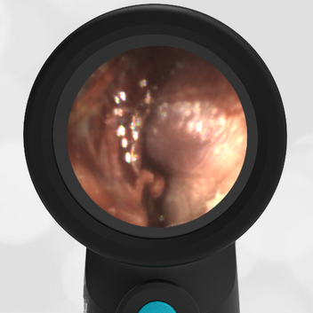 Nasal Septal Hematoma – WiscMed
