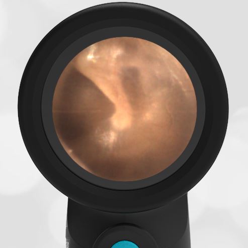 Normal Ear Drum Anatomy – WiscMed