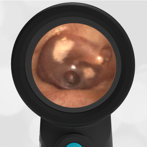 History of Tympanostomy Tubes (ear tubes) – WiscMed