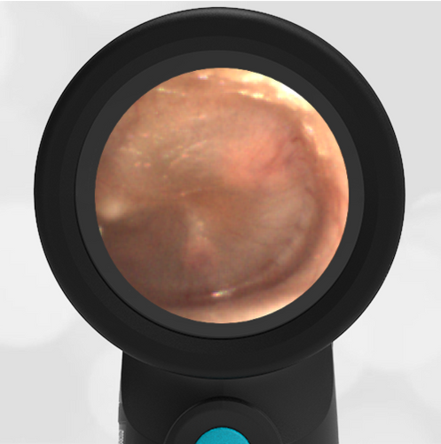 Resolving Acute Otitis Media (AOM) – WiscMed